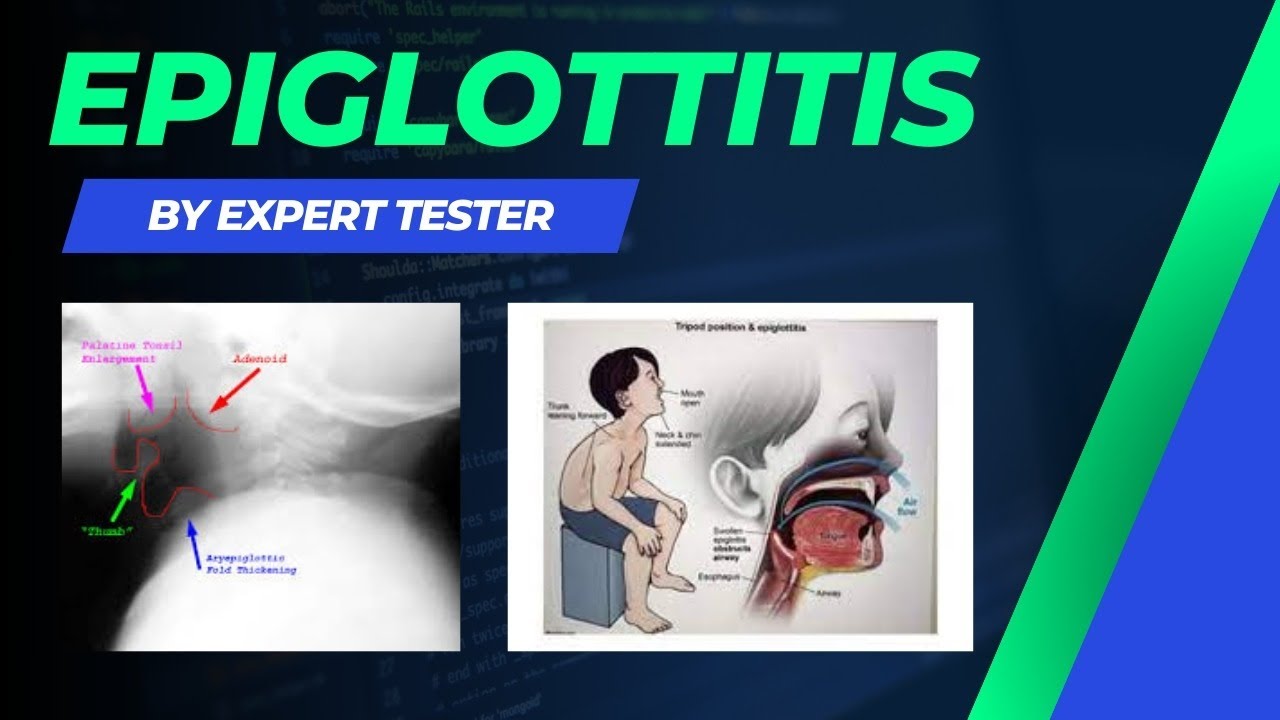 Epiglottitis | Causes , Symptoms , Diagnosis , Treatment & Pathology ...