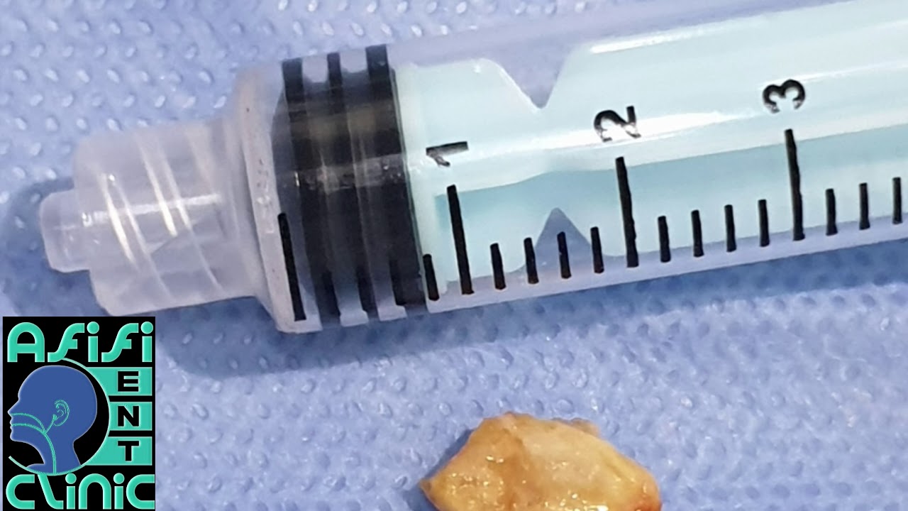 Endoscopic removal of bronchial foreign body, Dr. Afifi, MD - YouTube