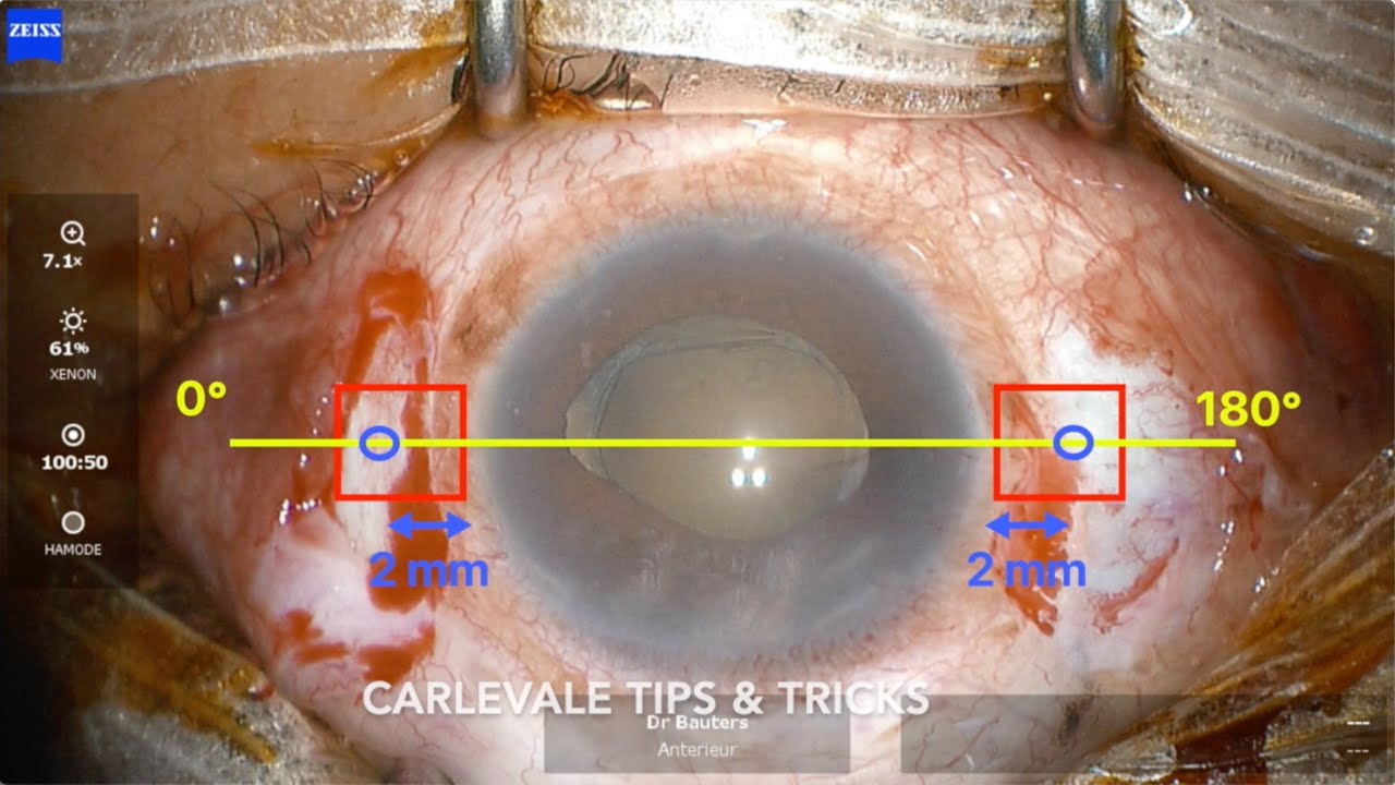Soleko Carlevale IOL implantation : Tips and Tricks - YouTube
