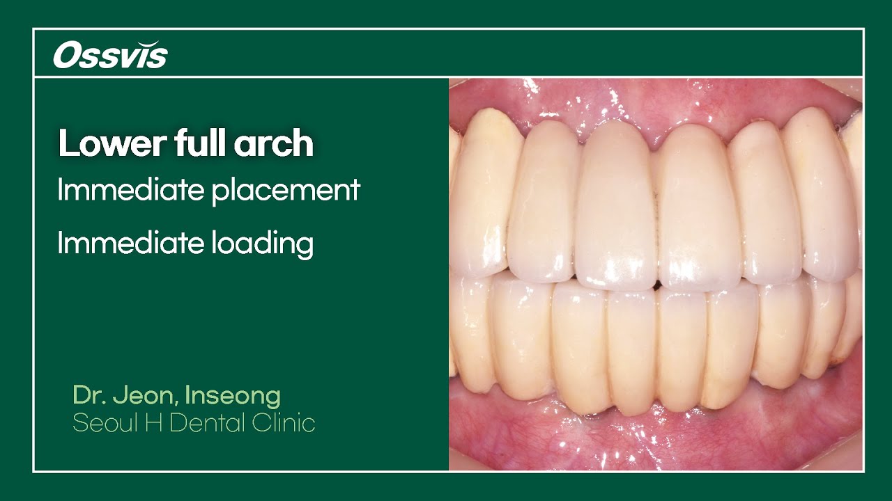 [Clinical Case] Lower full arch immediate placement & loading - YouTube