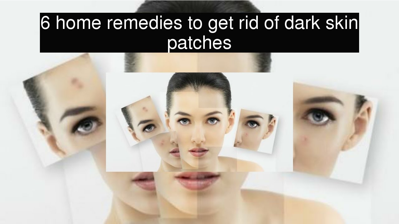 6 home remedies to get rid of dark skin patches - YouTube