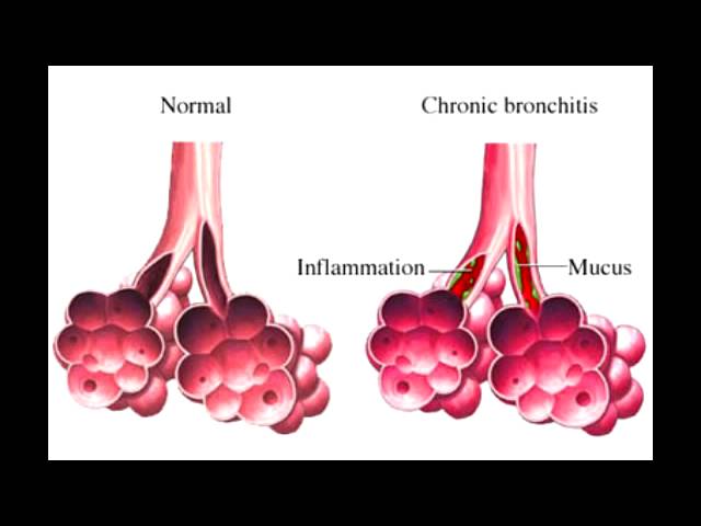 Chronic Bronchitis Blue Bloater