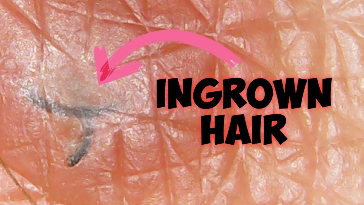 Ingrown Hair | red+juicy | - YouTube