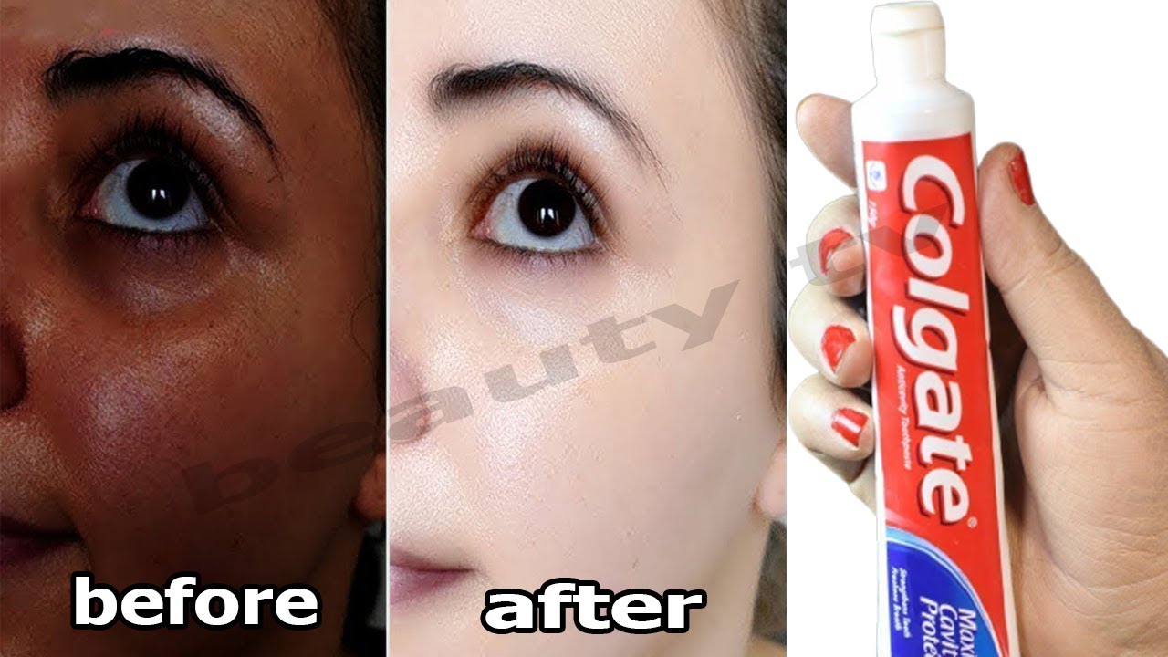 Apply Toothpaste on Your Skin and See Magical Result within 1 Hour ...