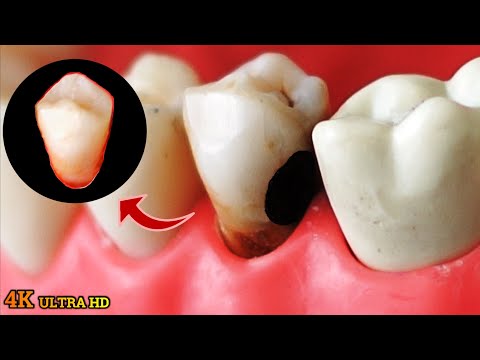 Awesome Restoration And Root Canal Treatment of a Severely Decayed ...