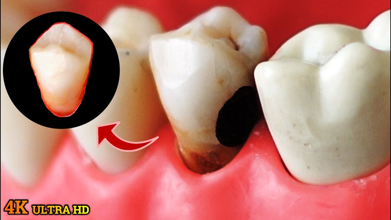 Restoration of a Tooth With Decayed Wall | Proximal Caries Restoration ...