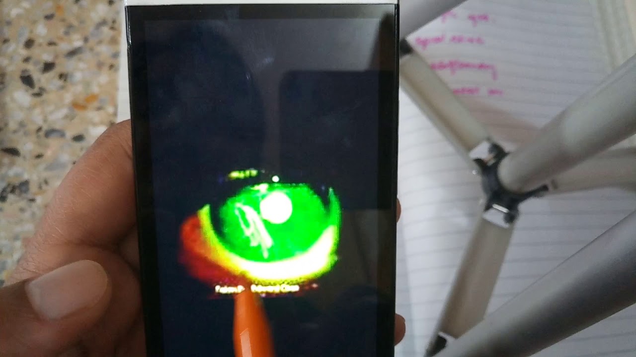 DRY EYE SYNDROME or KERATOCONJUNCTIVITIS SICCA with EXTREMELY IMPORTANT ...