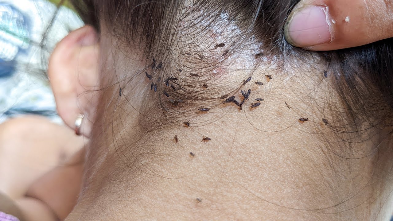 Wow there are a lot of big head lice - Take out thousand head lice ...
