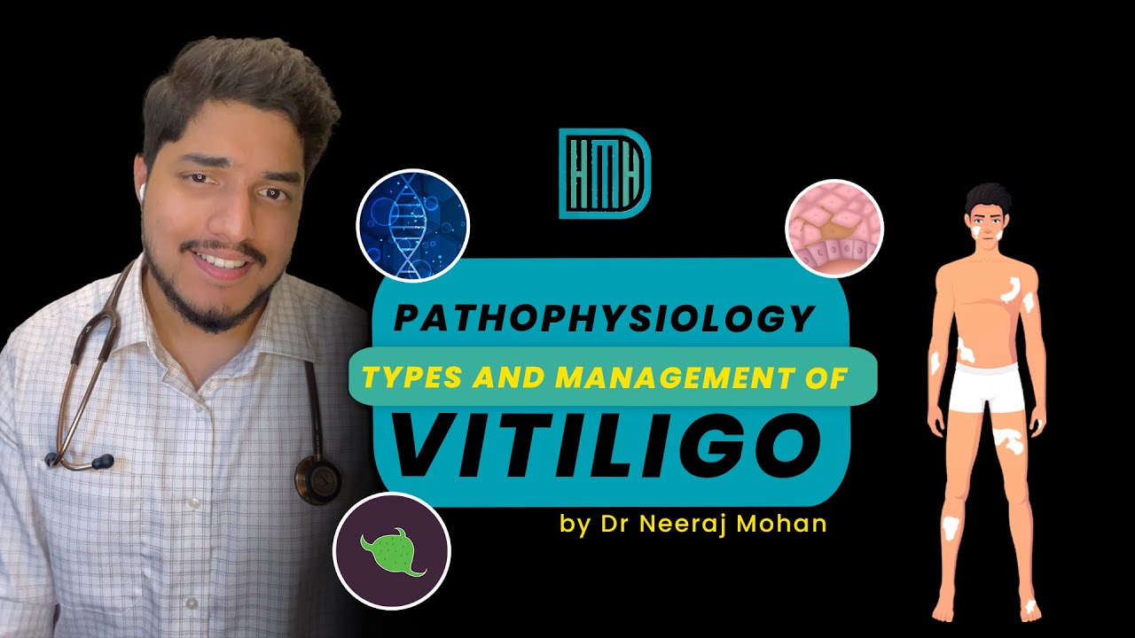 PATHOPHYSIOLOGY, TYPES AND MANAGEMENT OF VITILIGO BY DR. NEERAJ MOHAN ...