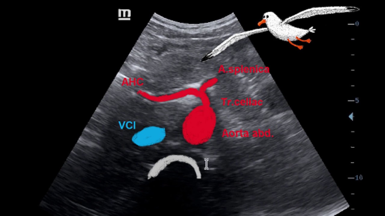 Trunchiul celiac . "Semnul pescarusului"/ "Seagull sign" - YouTube