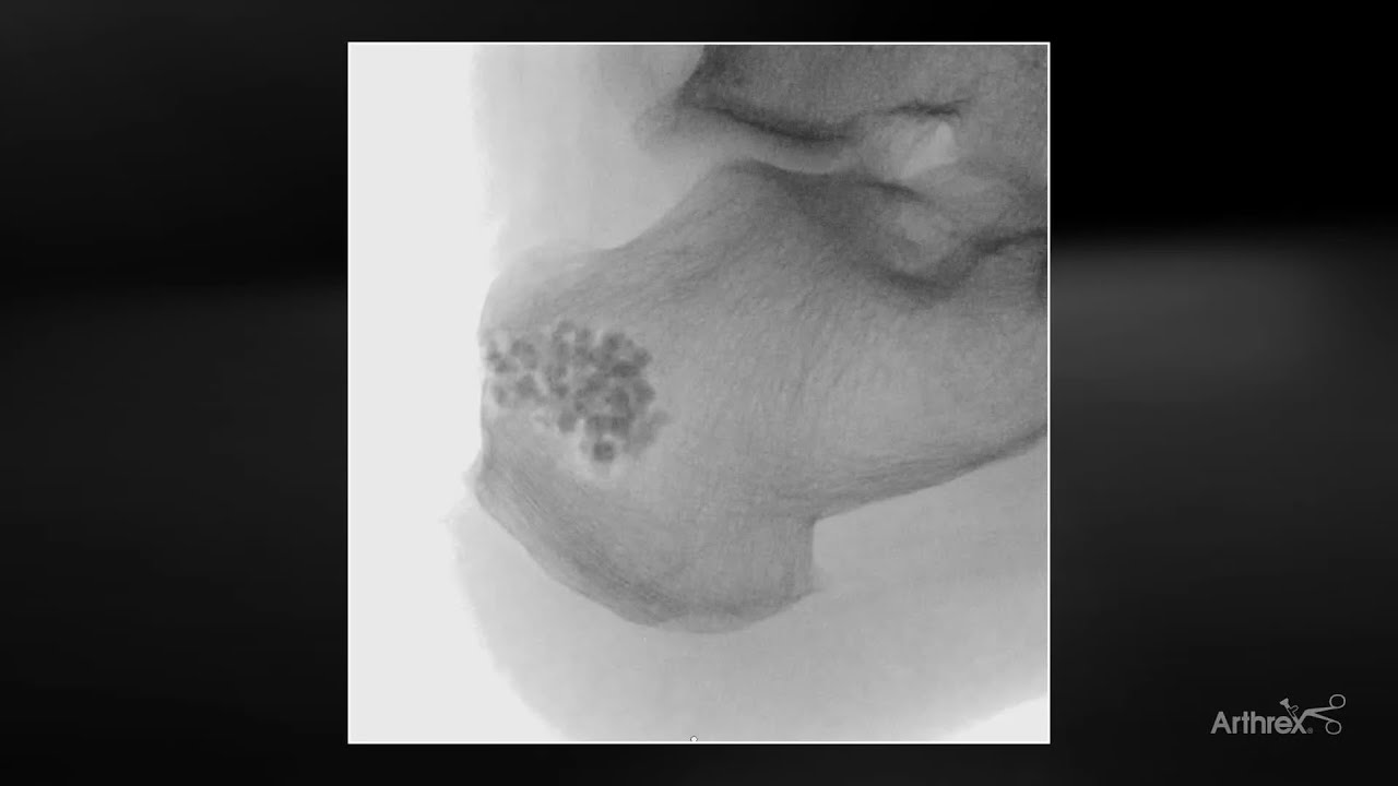 Arthrex Calcium Sulfate BioBeads for Osteomyelitis of the Calcaneus ...