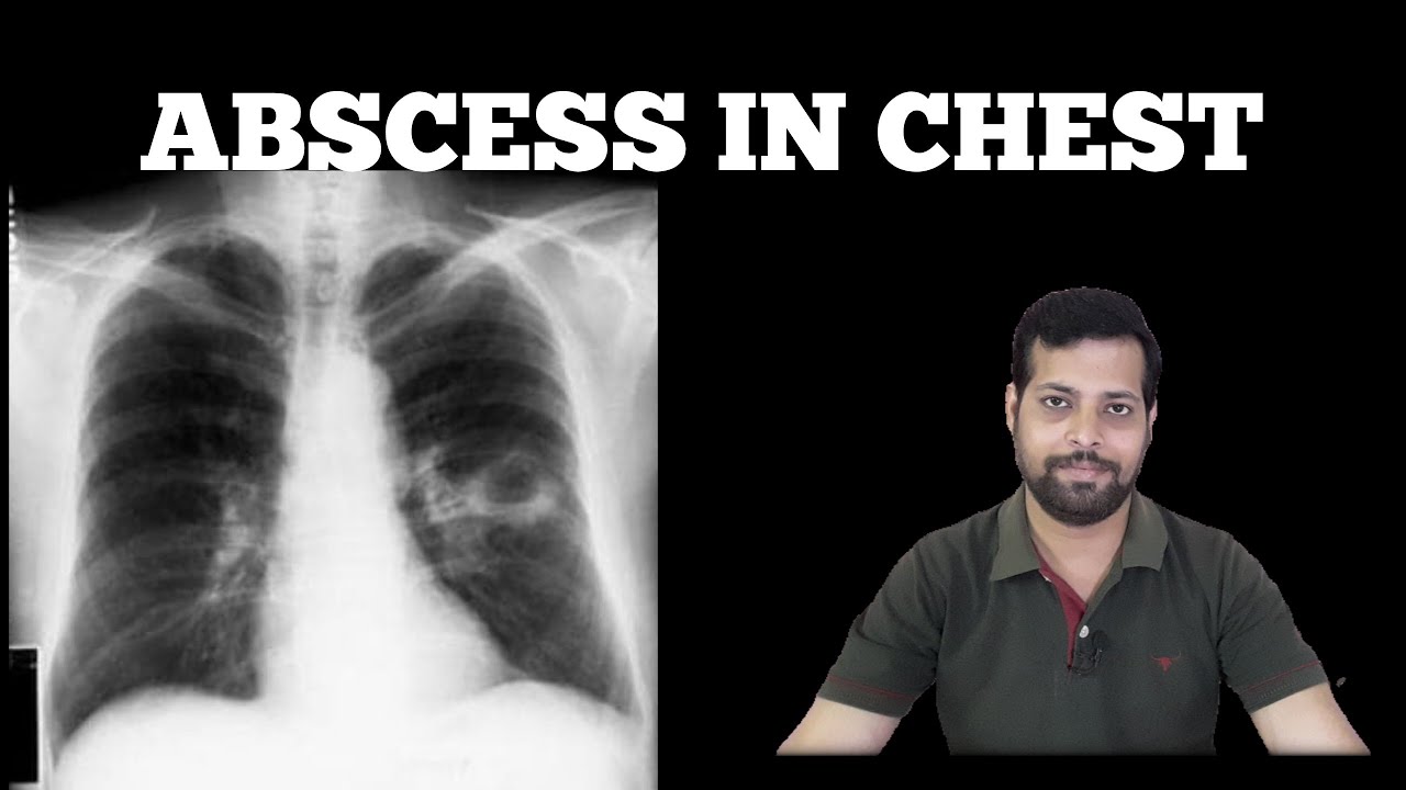 chest abscess - YouTube