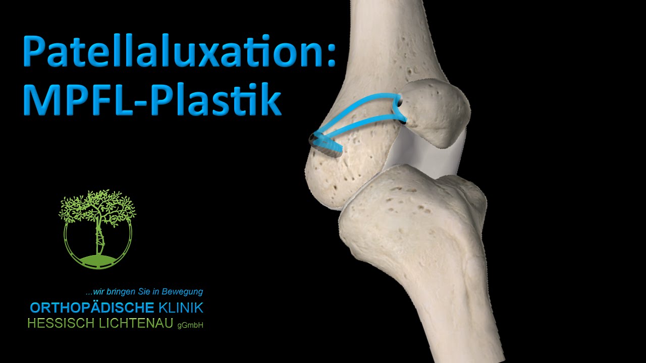 Patellaluxation Teil 2 - YouTube