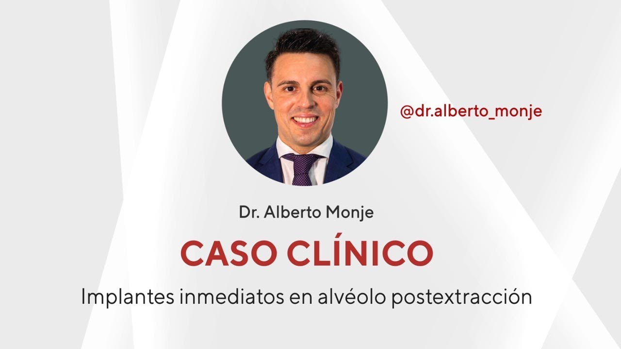 Caso: Implantes inmediatos en alvéolo postextracción - Dr. Alberto ...