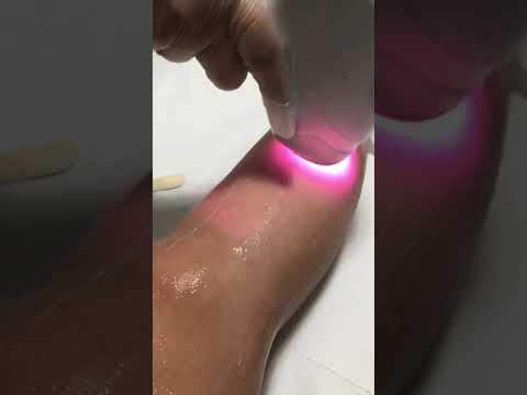 Buz diod lazer Epilasyon sistemi nedir?