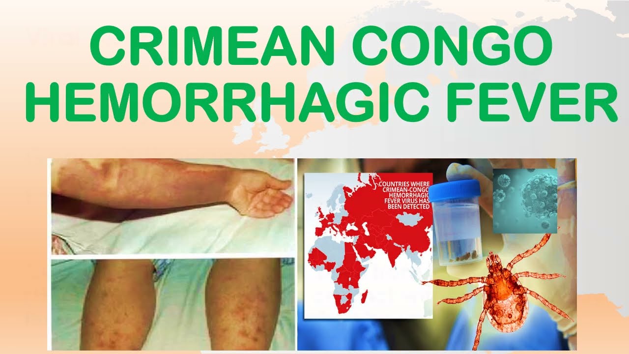 കോംഗോ പനി - Crimean congo hemorrhagic fever: symptoms,prevention ...
