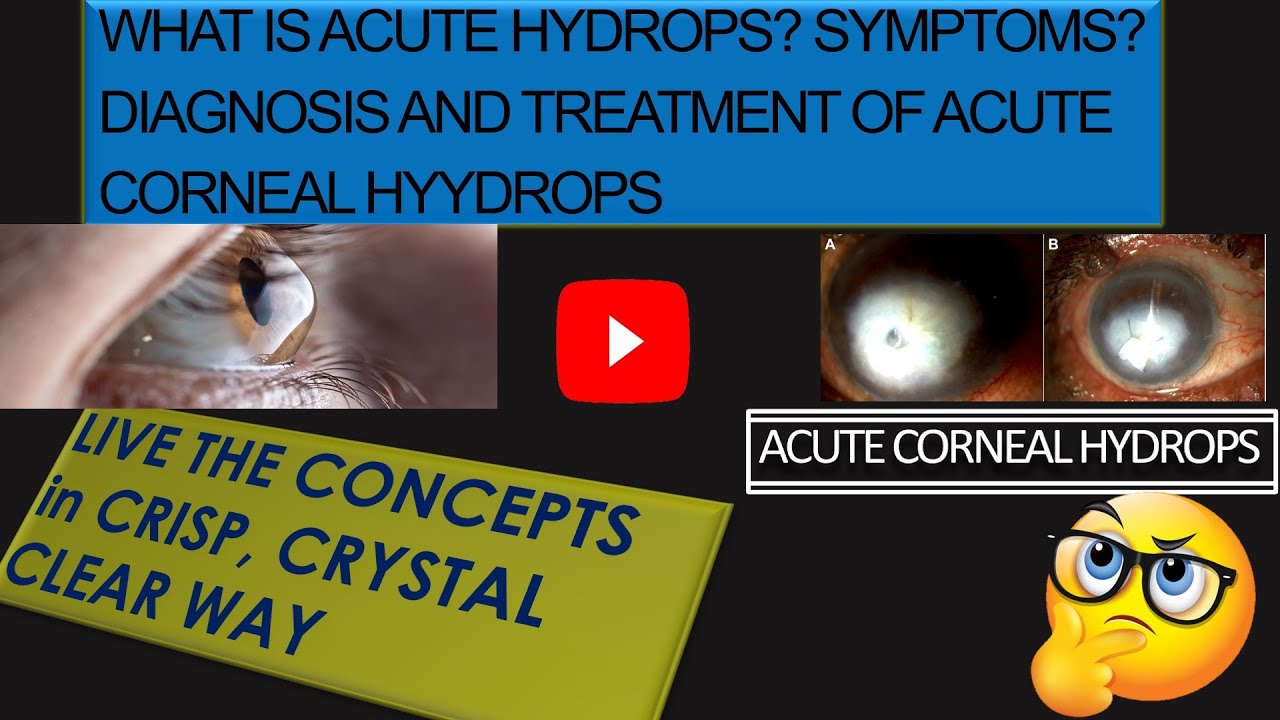 WHAT IS ACUTE CORNEAL HYDROPS? SYMPTOMS? DIAGNOSIS AND TREATMENT OF ...