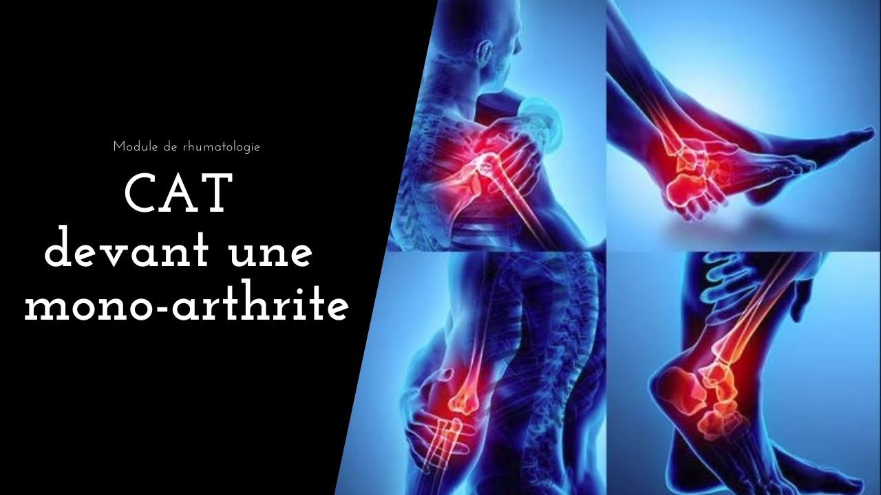 CAT devant une mono arthrite - YouTube