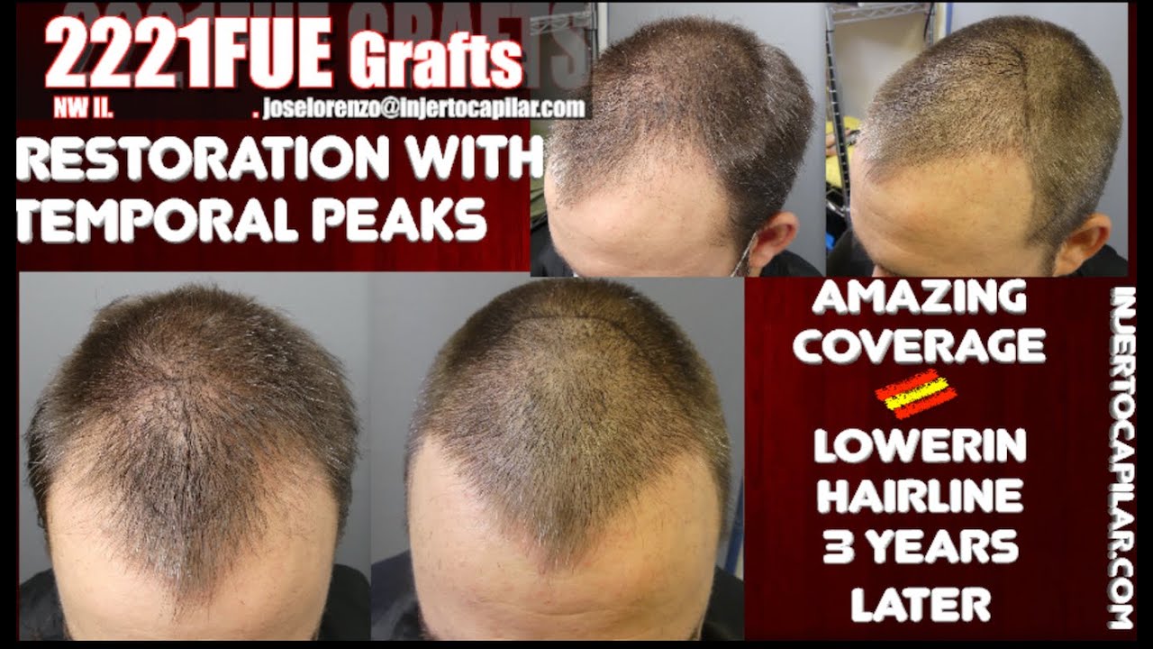 2221FUE Grafts. NW II. Restoration with temporal peaks. Lowering ...