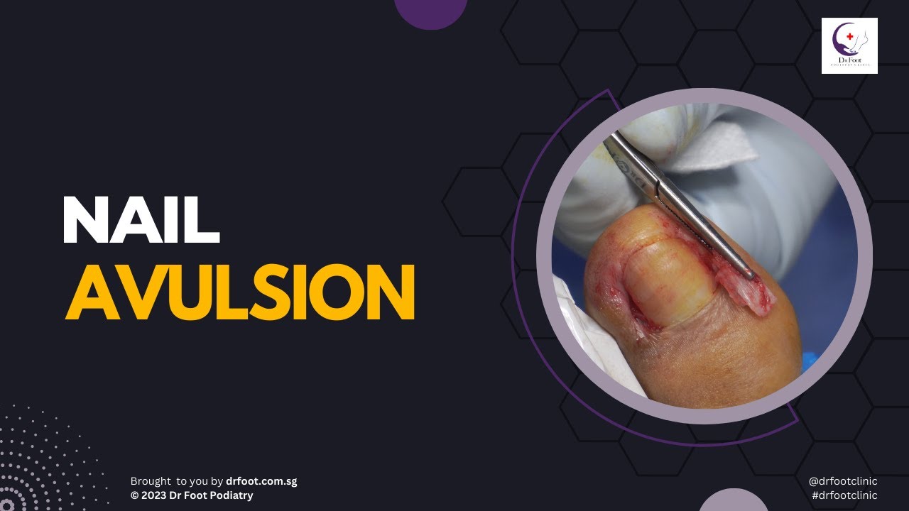 Nail Avulsion on both Left and Right Toes! - YouTube