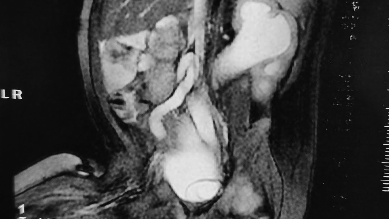 Cystoscopy puncture of ectopic ureterocele @Pediatric-Urologist - YouTube