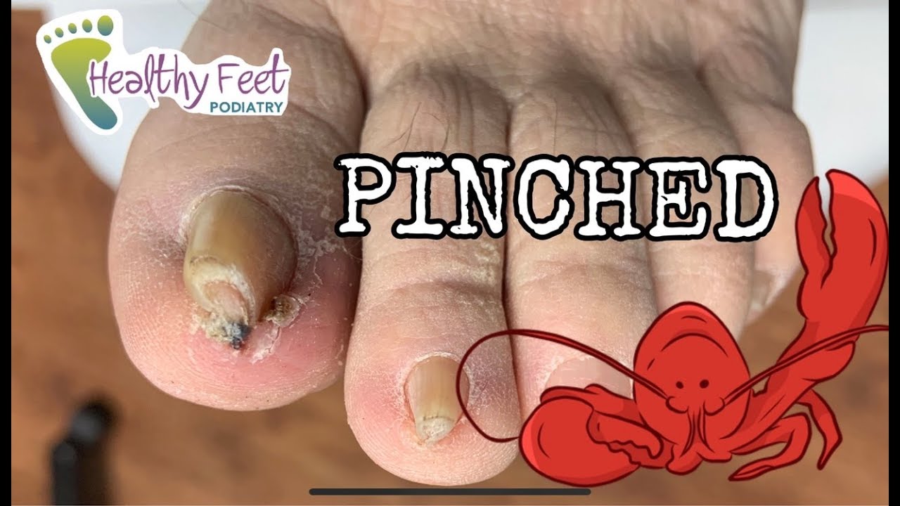 Painful Pinched Toe Nail - YouTube