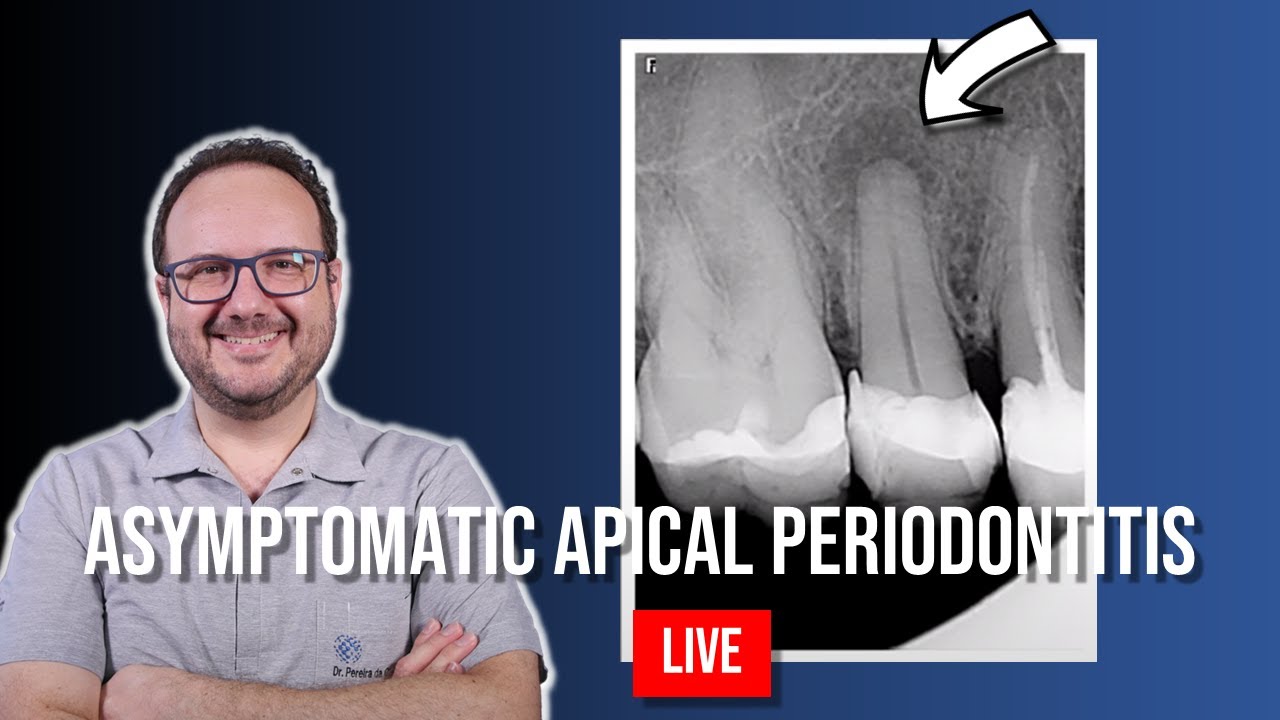 Endo Treatment of Asyntomatic Apical Periodontitis of 15 - Part 1 - YouTube