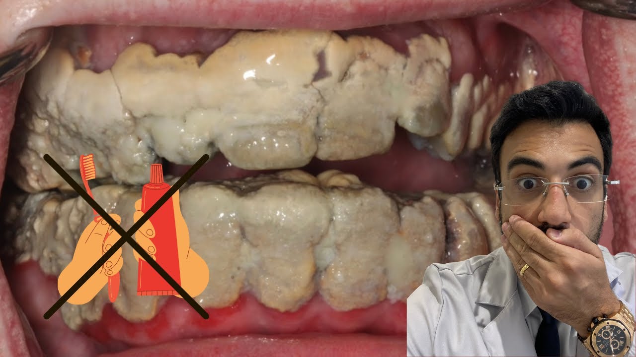 20 ANOS SEM ESCOVAR OS DENTES 😱 VEJA ESTE CASO - YouTube