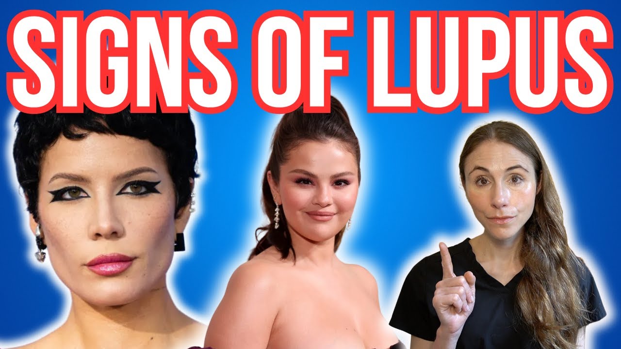 Signs Of Lupus Not To Miss | Butterfly Rash & MORE - YouTube