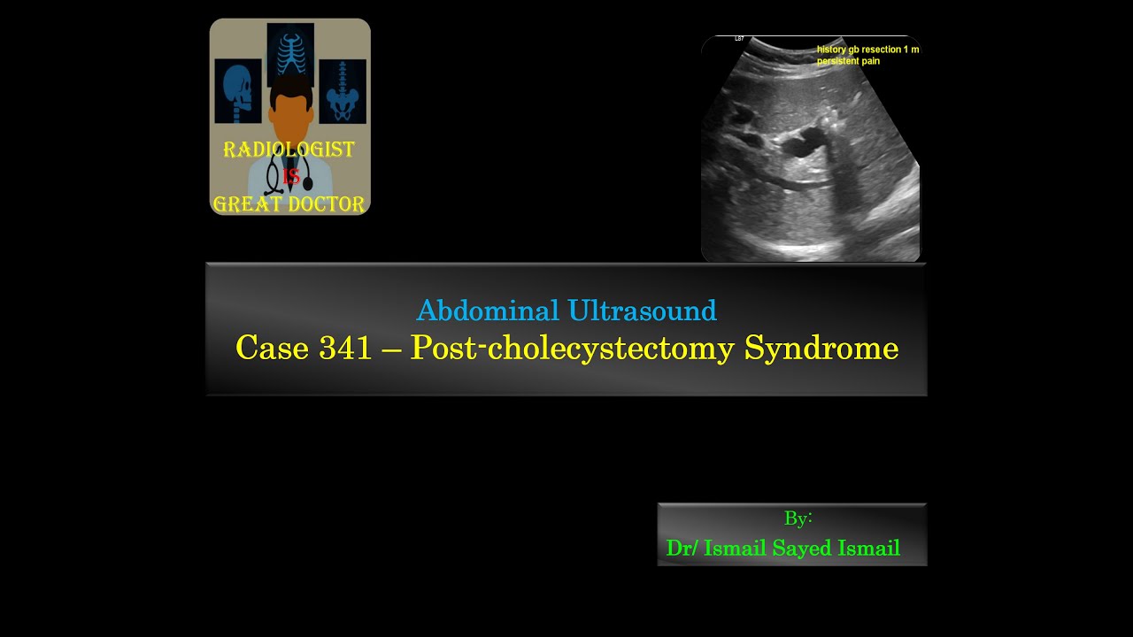 Ultrasound Case 341 - Post-cholecystectomy Syndrome - YouTube
