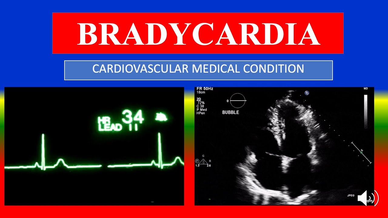 BRADYCARDIA - Definition, types, causes, pathophysiology, symptoms ...