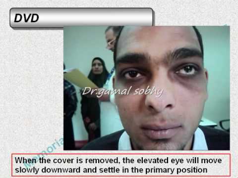 Dissociated Strabismus - YouTube