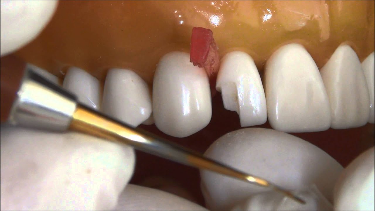 Class IV restoration with A+matrix - NDEB - YouTube