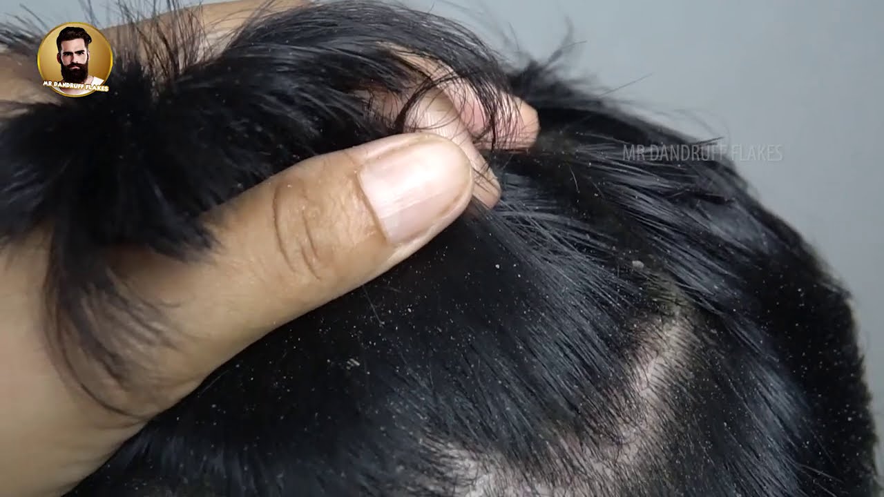 Huge Dandruff Flakes On Scalp Scratching #64 - YouTube