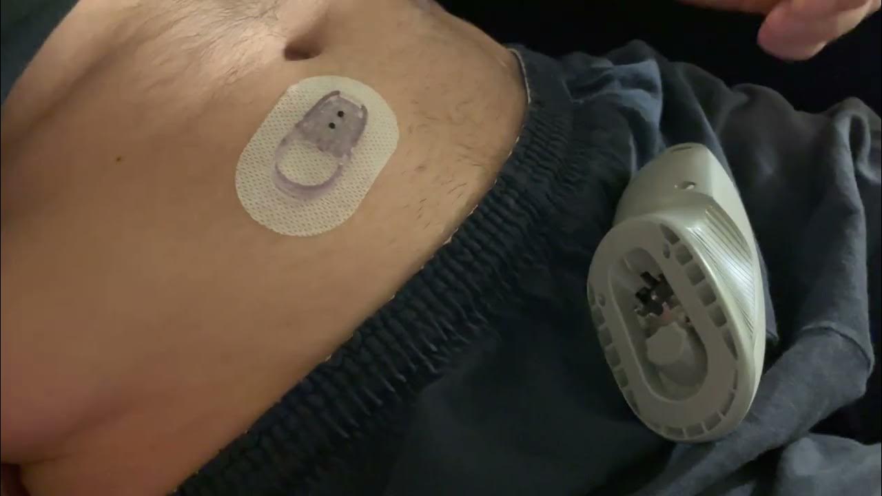 Dexcom G6 Sensor Lower Abdomen Insertion Site - YouTube