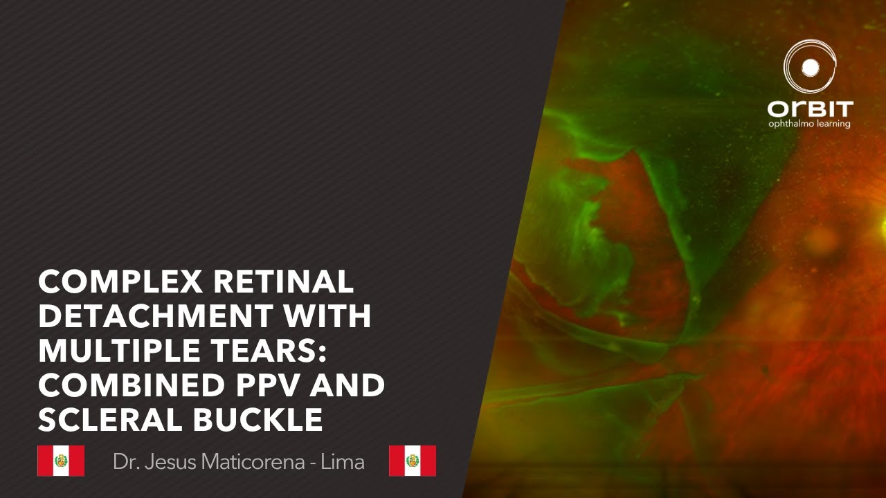 Complex Retinal Detachment with Multiple Tears: Combined PPV and ...