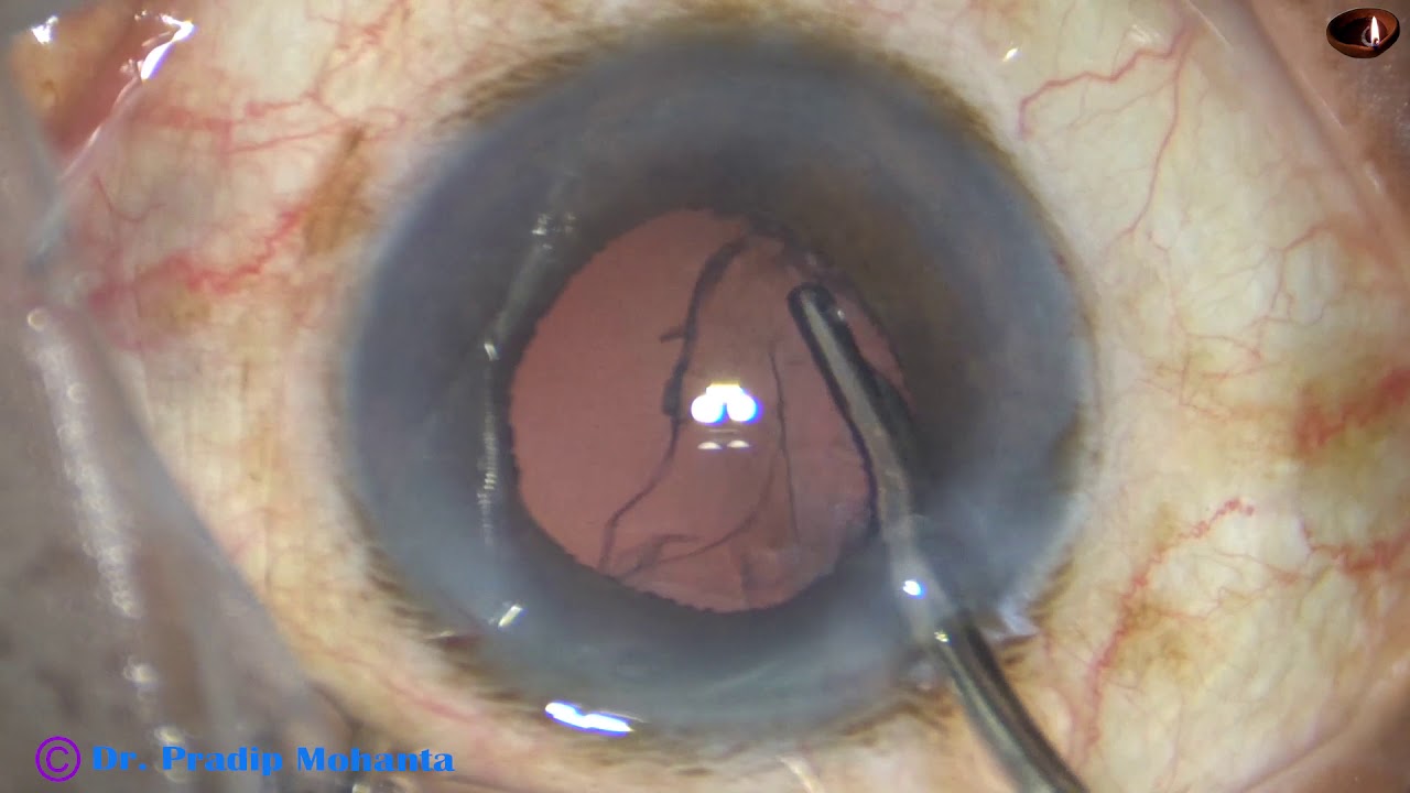 Remove the Phaco-needle first, Respect the Iris : Pradip Mohanta, 3rd ...