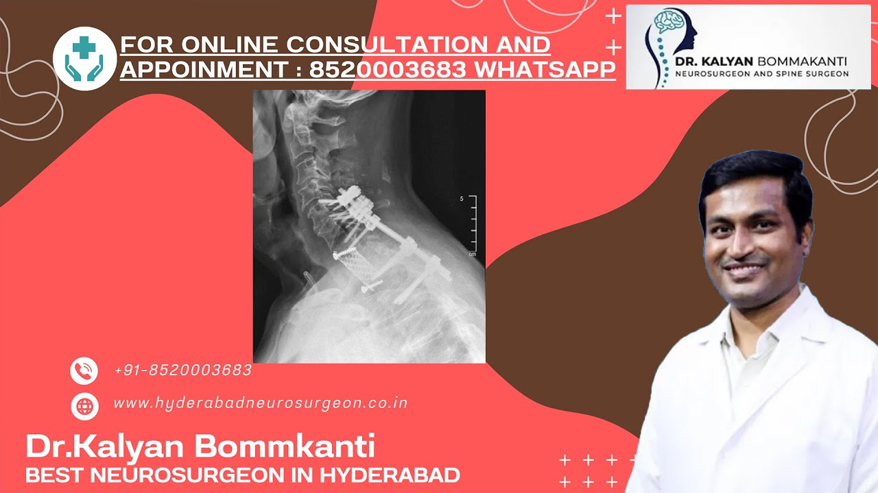 C1-C2 Fixation for Traumatic C2 fracture and Atlantoaxial Dislocation ...