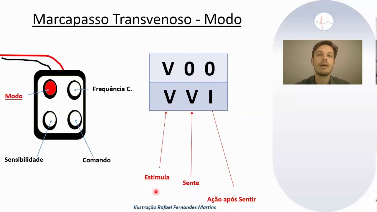 Passagem de Marcapasso transvenoso e ajustes - YouTube