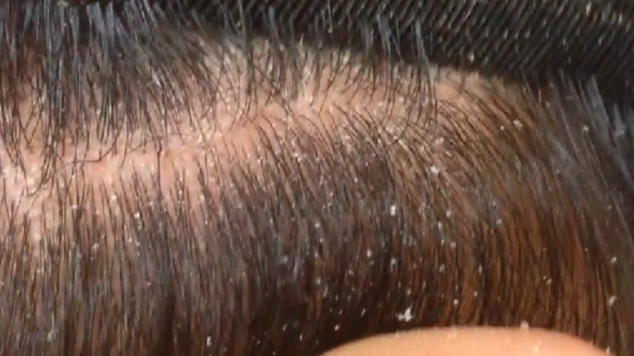 Dandruff Removal Dandruff Extreme Dandruff Scratching Asmr
