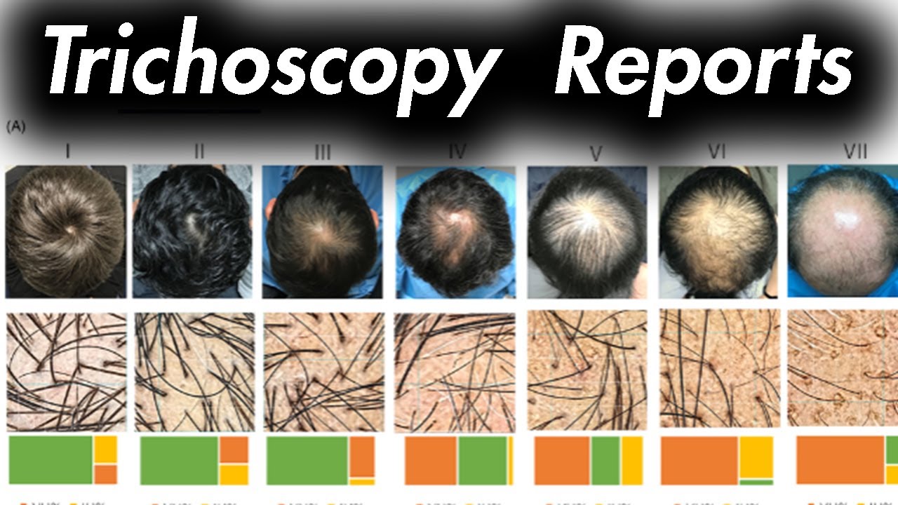 How to Predict Hair Loss | The Trichoscopy Report - YouTube