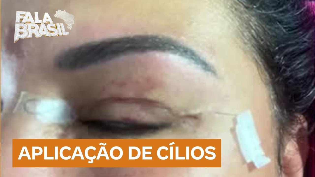Aplicação de cílios postiços pode provocar alergia e inflamação nos ...