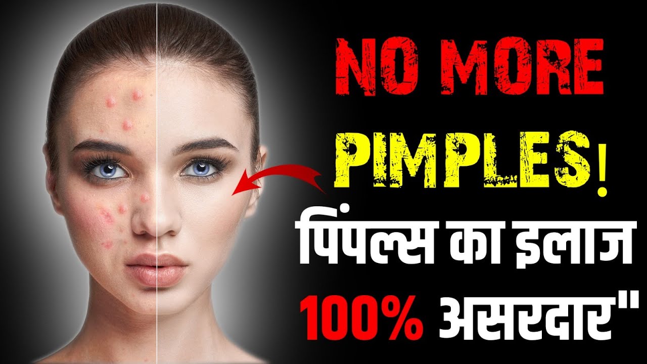 अपना Face ख़राब मत करो | Pimple, Acne | How to Remove Pimple | Easy ...