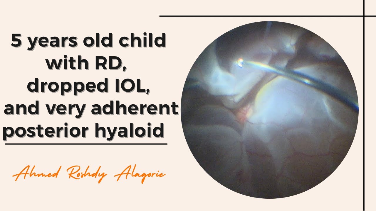 5 years old child with subtotal retinal detachment, dropped IOL, and ...