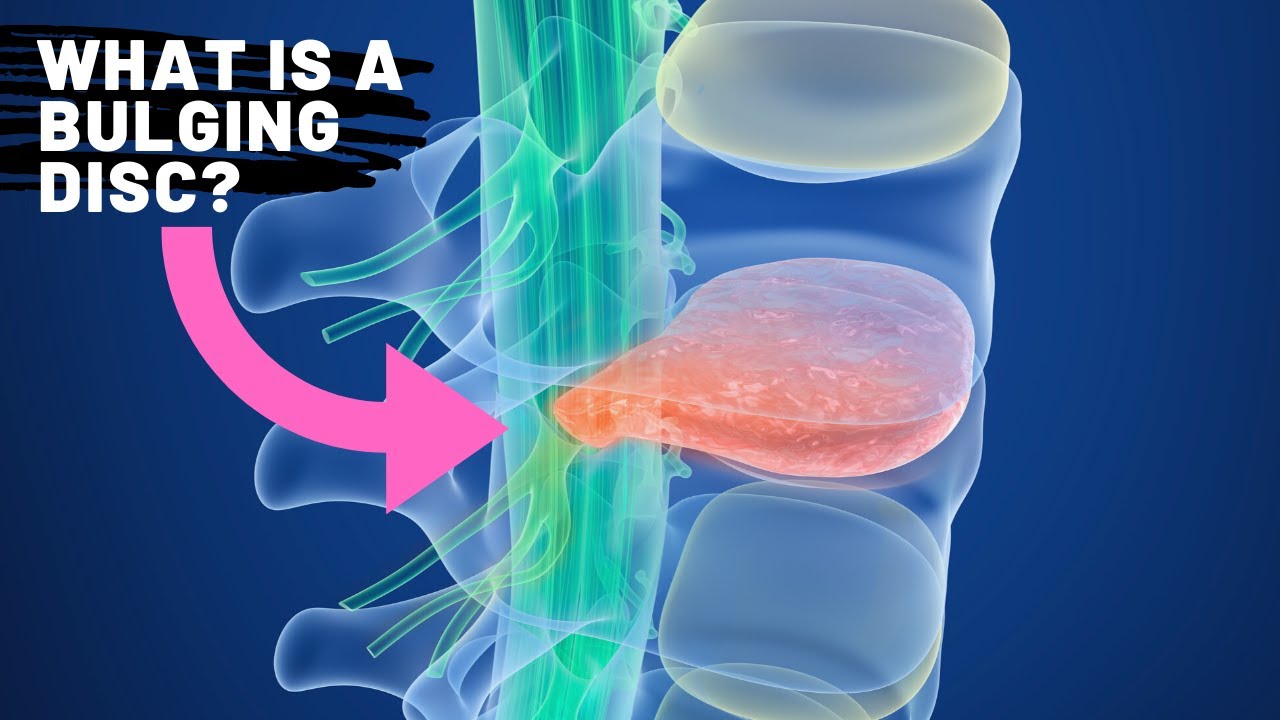 What is a bulging disc? - YouTube