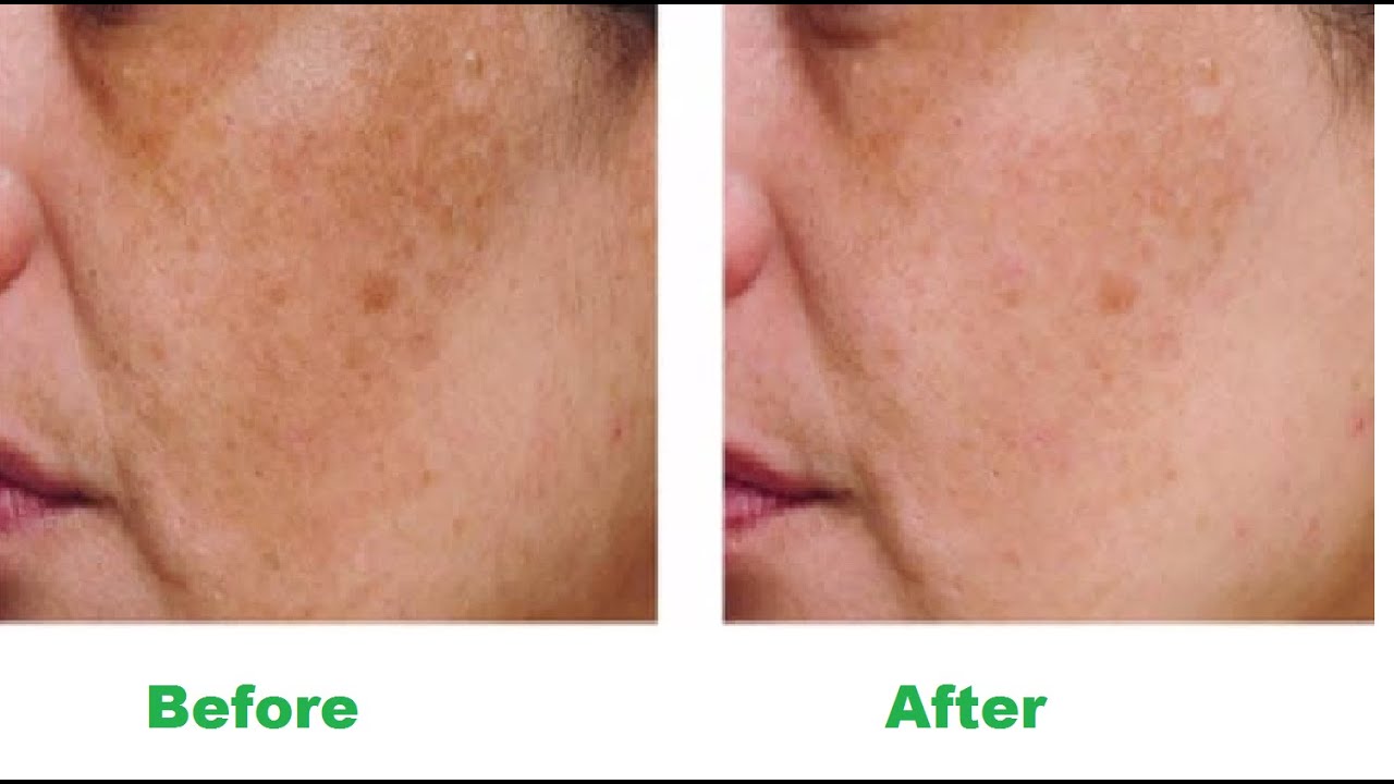 Kozisol Plu Gel Review| For removing skin pigmentation,age spot,acne ...