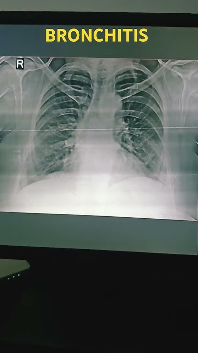 XRAY-CHESTPA BRONCHITIS (BVM)ARE#PROMINENT VEW - YouTube