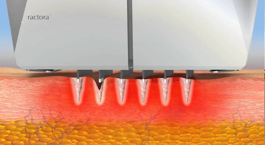 Fractora Animation - YouTube