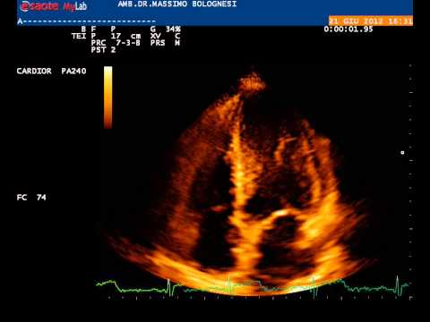apical 4 chamber view LV apical akinesis - YouTube