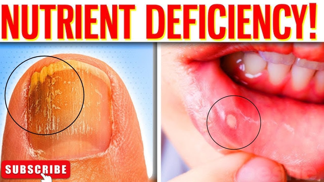 15 SIGNS OF NUTRIENT DEFICIENCY YOU SHOULD WATCH OUT FOR# ...